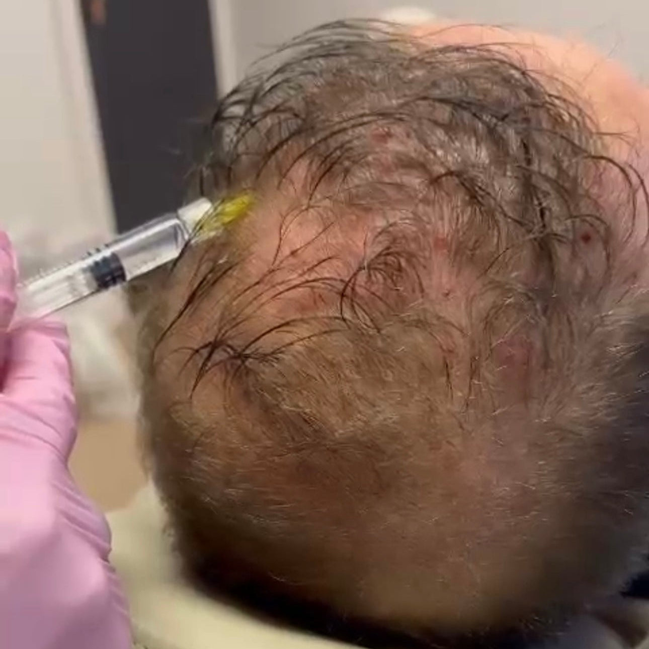 HAIR GROWTH – Renovo Aesthetics