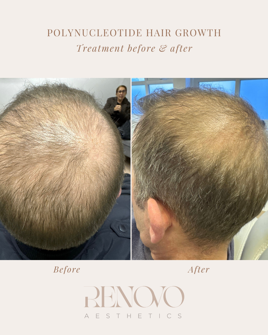 Polynucleotide Hair Growth Treatment – Renovo Aesthetics